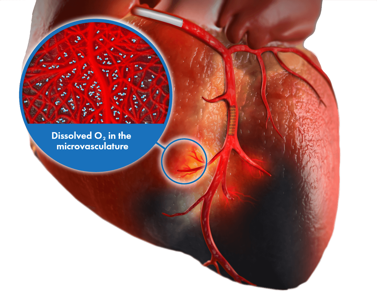 TherOx SuperSaturated Oxygen (SSO2) Therapy for STEMI Care - ZOLL Medical